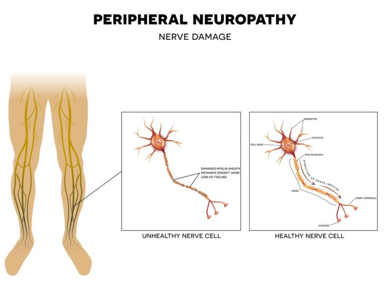 Peripheral Neuropathy - Get "Heeled" at Hadfield Foot and Ankle - Dr ...