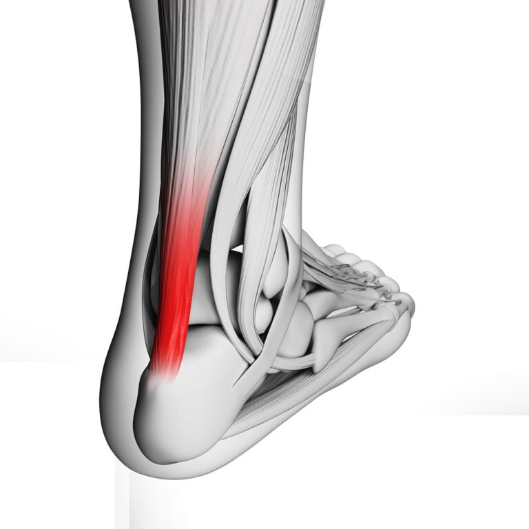 Tendonitis - Get "Heeled" at Hadfield Foot and Ankle - Dr. Robert ...